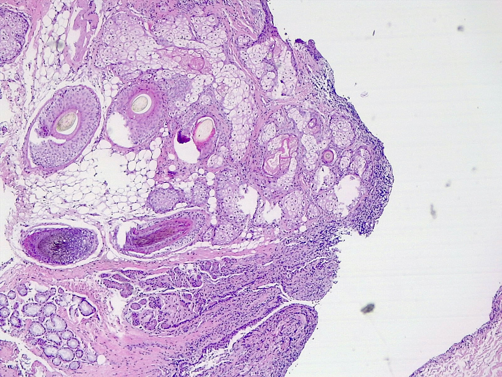 Pathology Outlines - Somatic neoplasms arising from teratomas