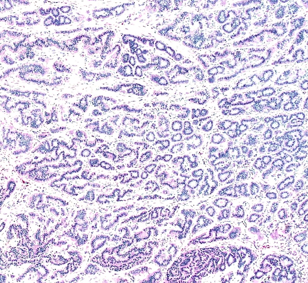 Pathology Outlines - Carcinoid tumor
