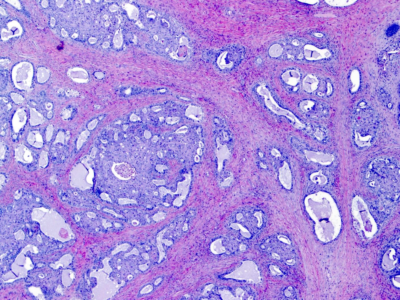 Pathology Outlines - Endometrioid borderline tumor