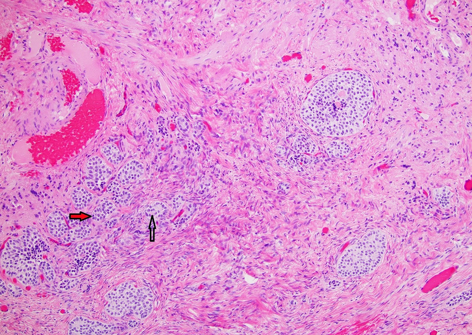 Pathology Outlines - Gonadoblastoma