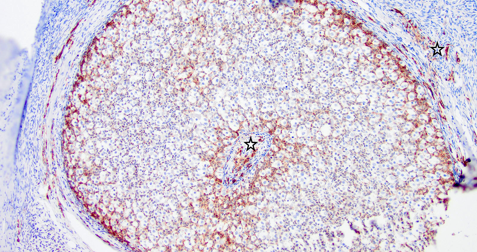 Pathology Outlines - Gonadoblastoma