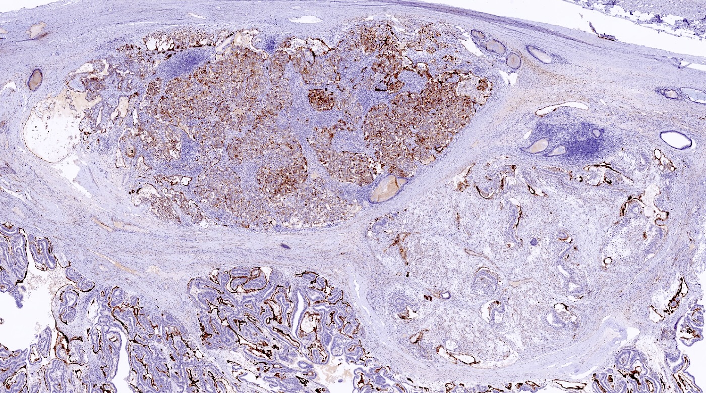 Pathology Outlines - Mixed germ cell tumor