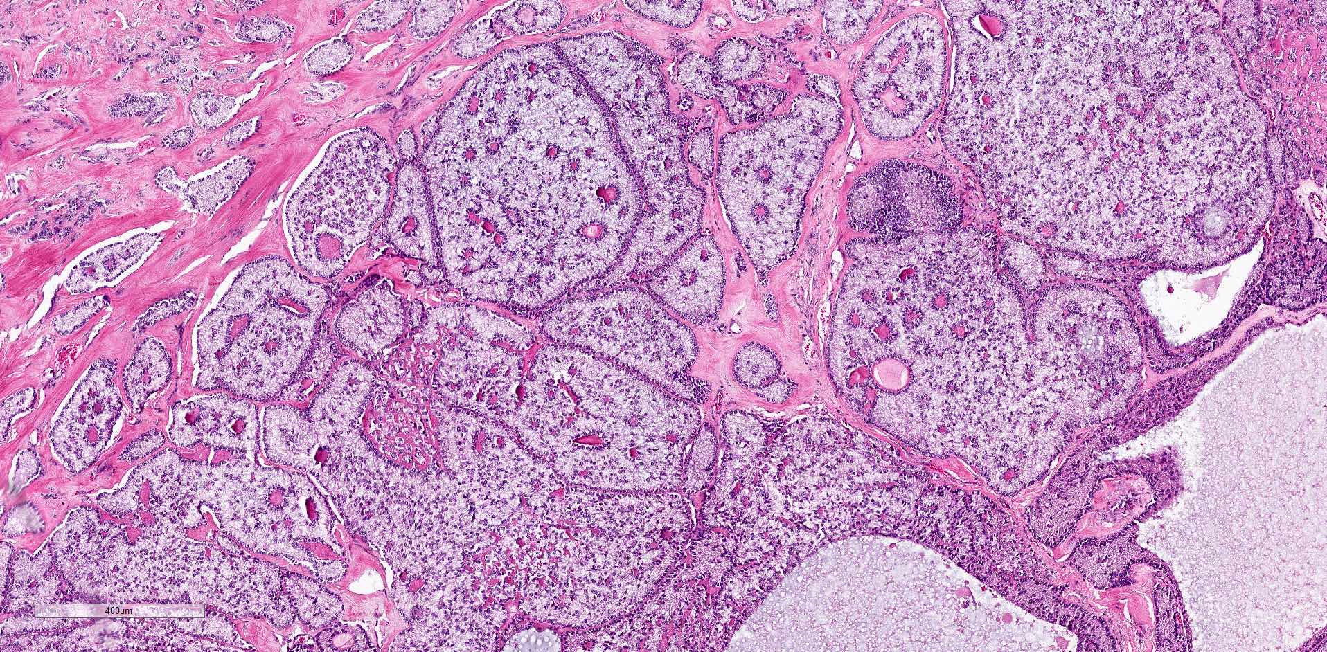 Pathology Outlines Sex Cord Tumor With Annular Tubules