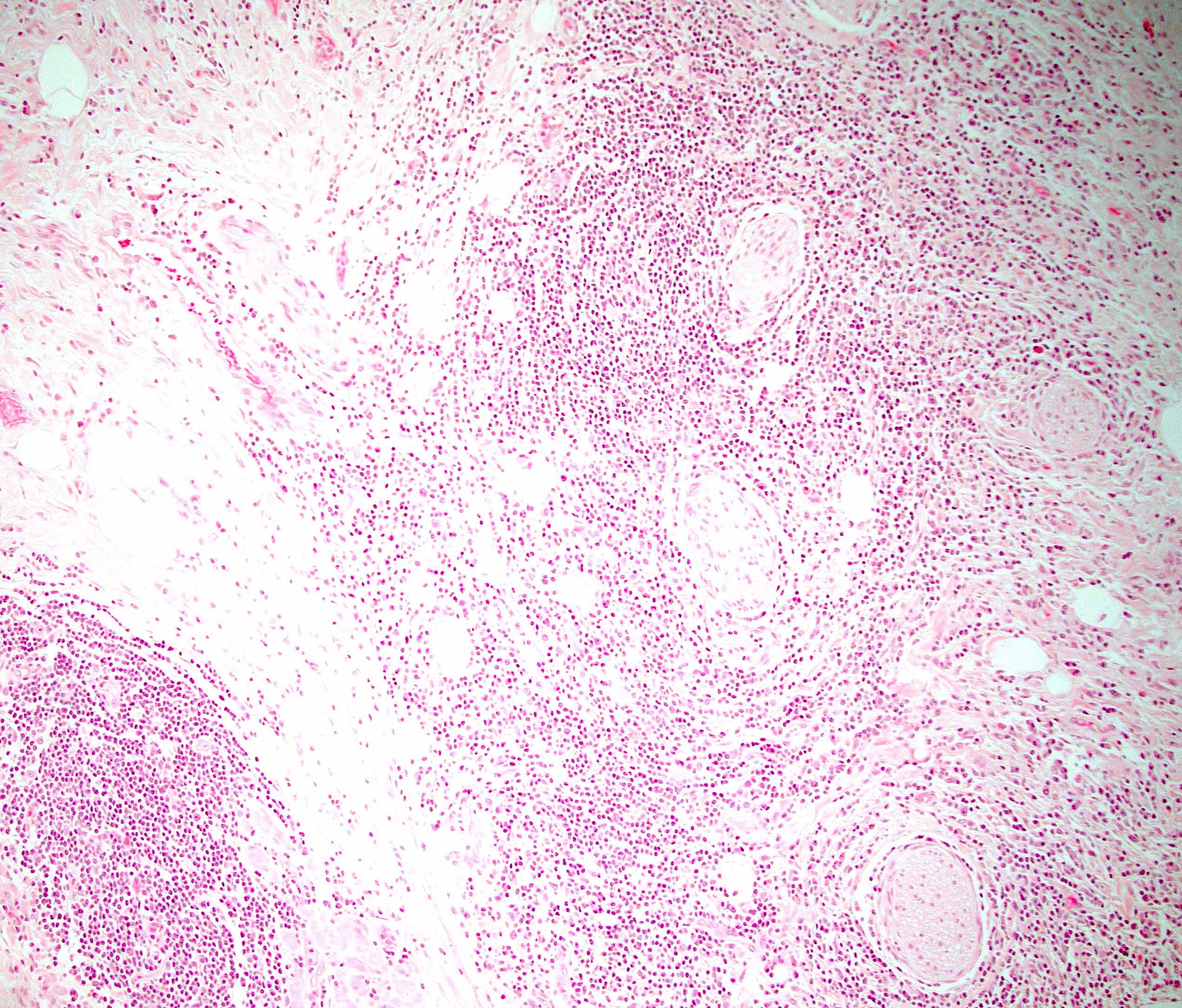Pathology Outlines - Autoimmune pancreatitis type 1