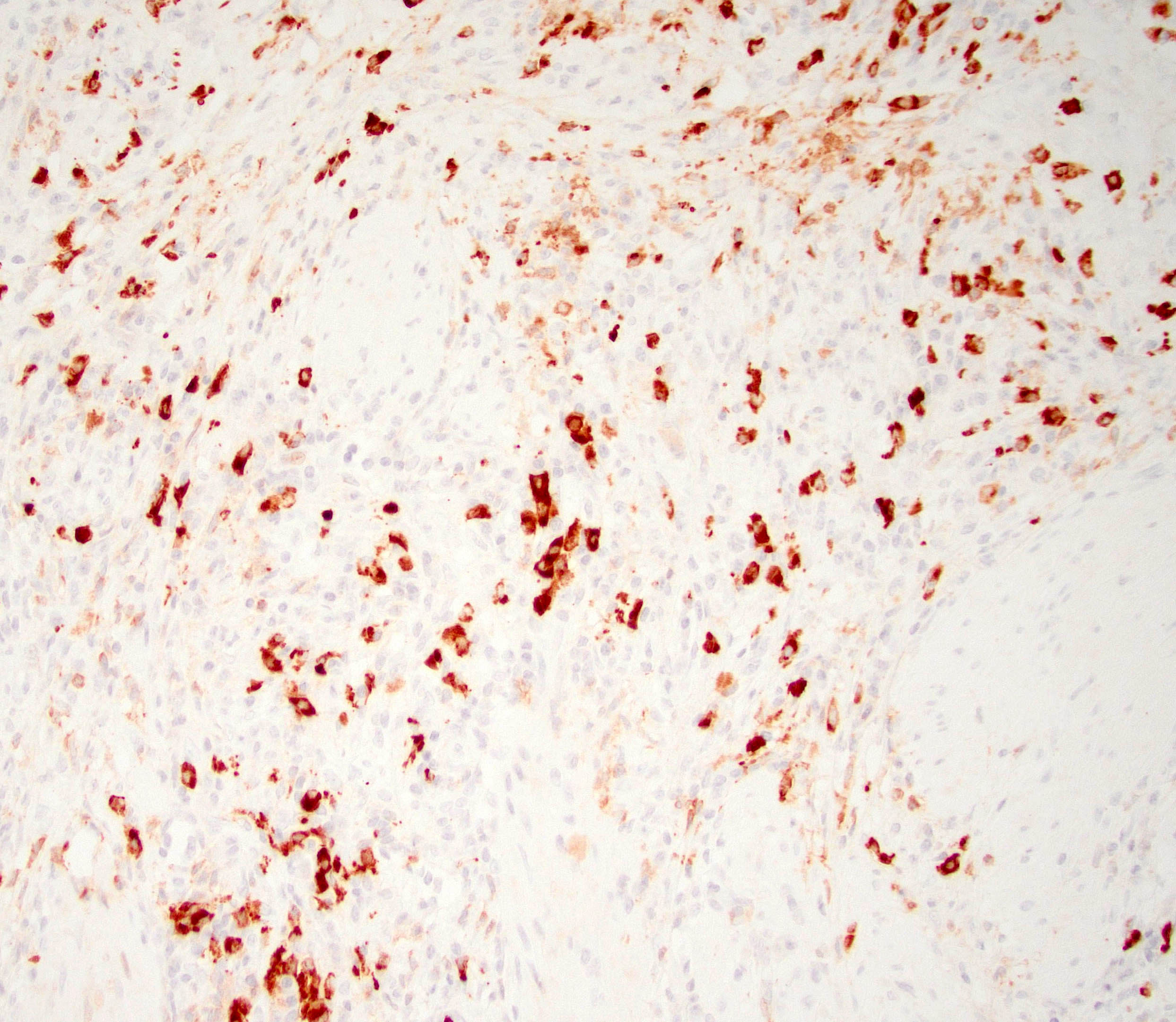 Pathology Outlines - Autoimmune pancreatitis type 1