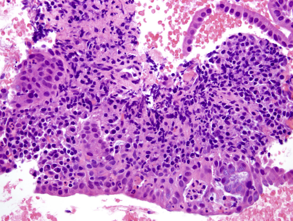 Pathology Outlines - Autoimmune pancreatitis type 2