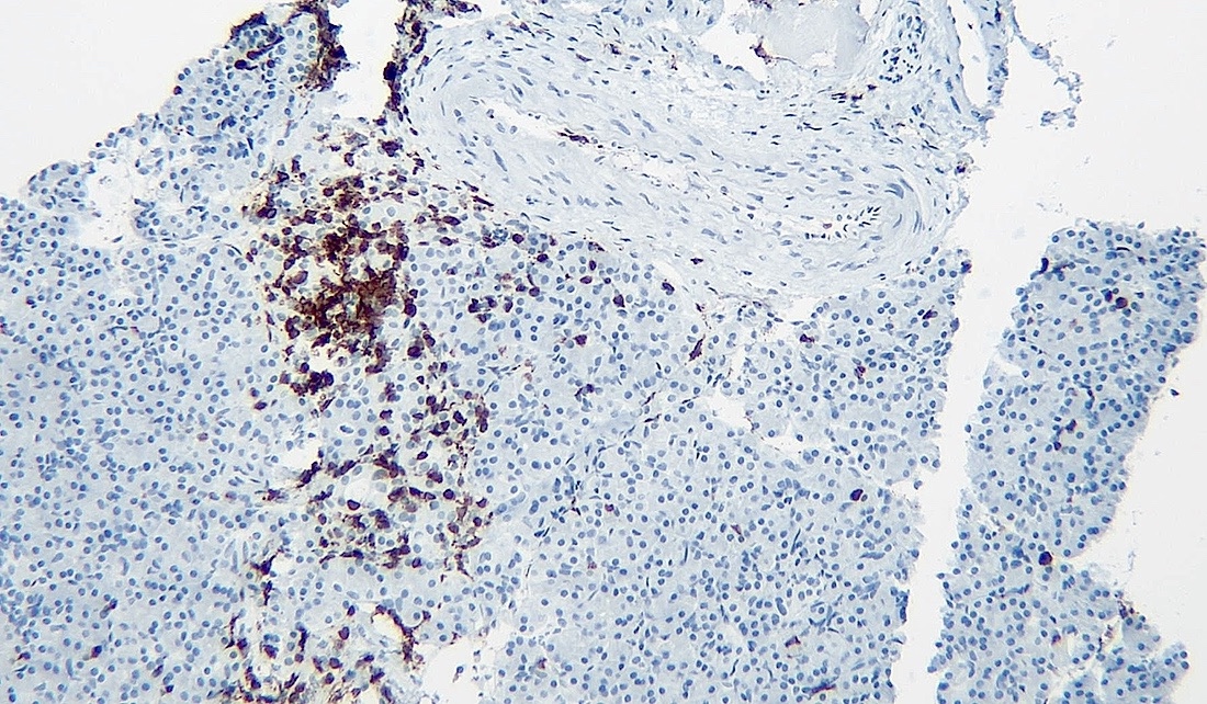 Pathology Outlines - Allograft rejection