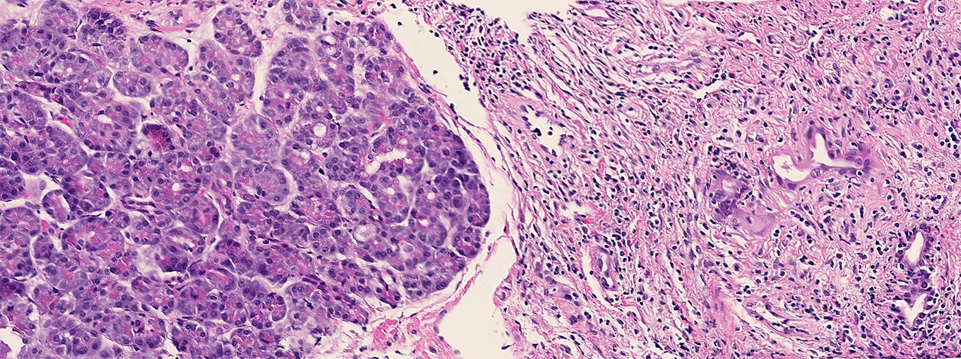 Pathology Outlines - Allograft rejection
