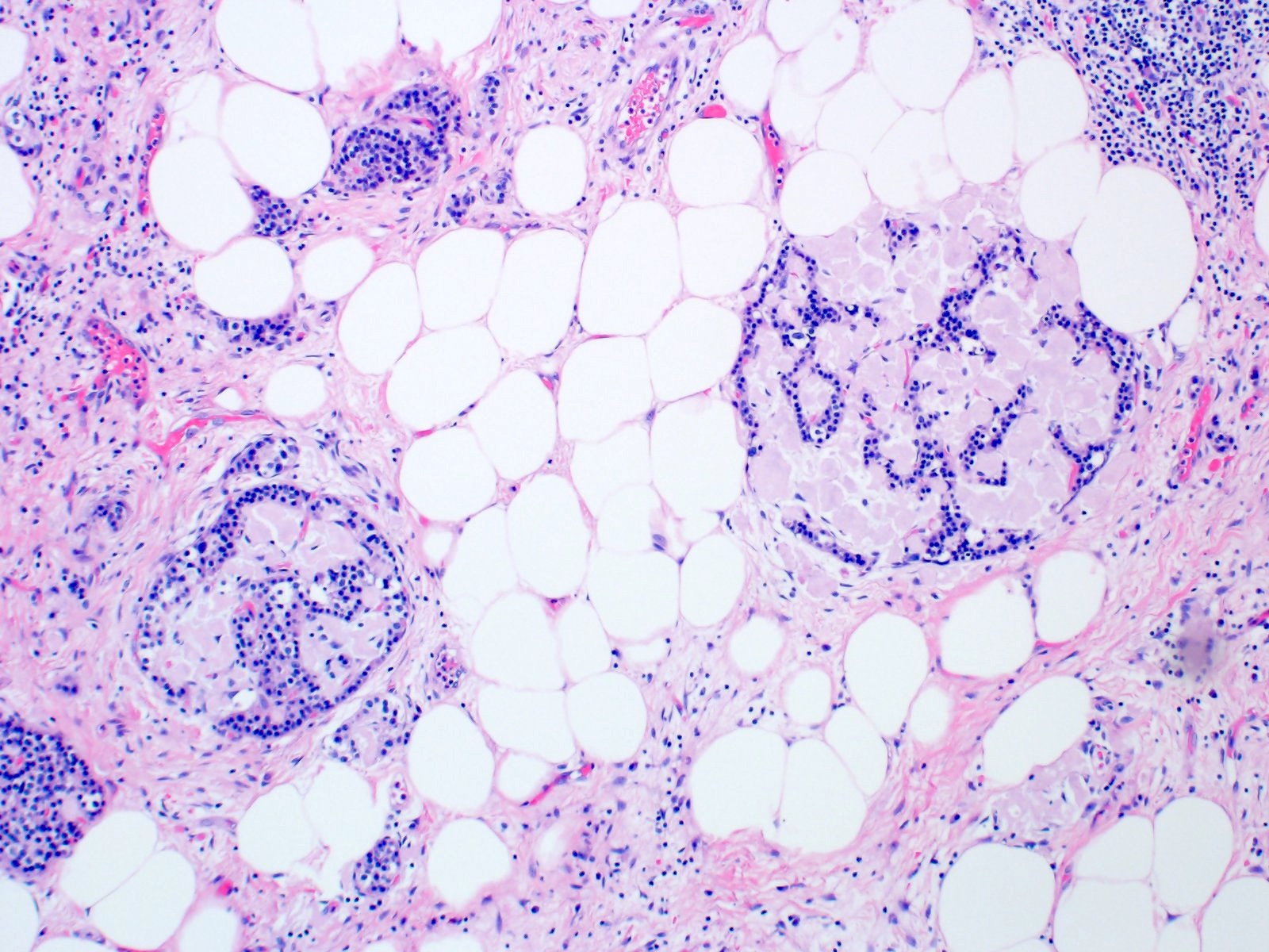 Type 1 Diabetes Pancreas Histology