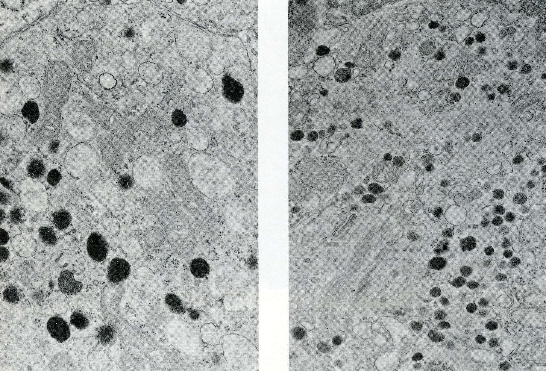 Pathology Outlines - Gastrinoma