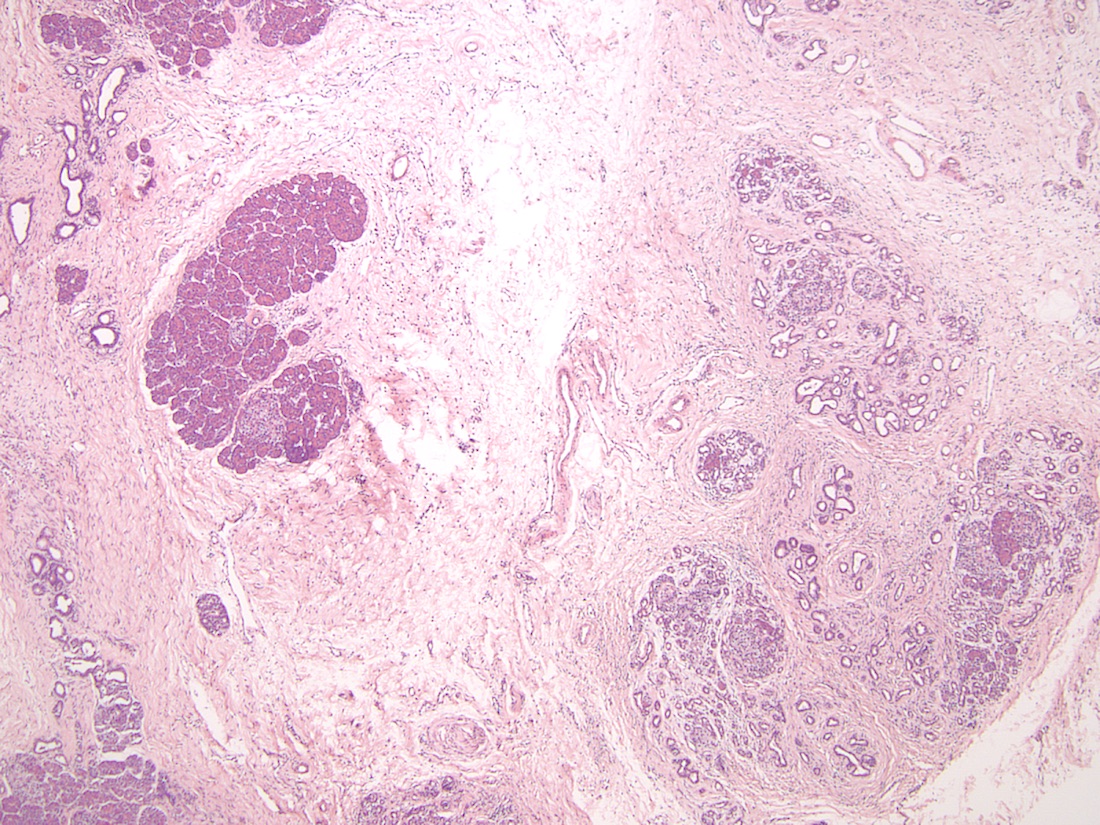 Pathology Outlines - PRSS1 hereditary pancreatitis