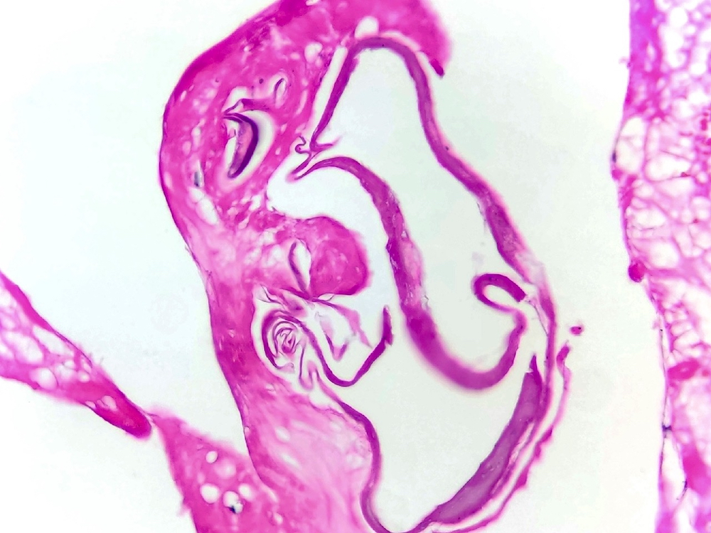 Pathology Outlines - Taenia solium (neurocysticercosis)