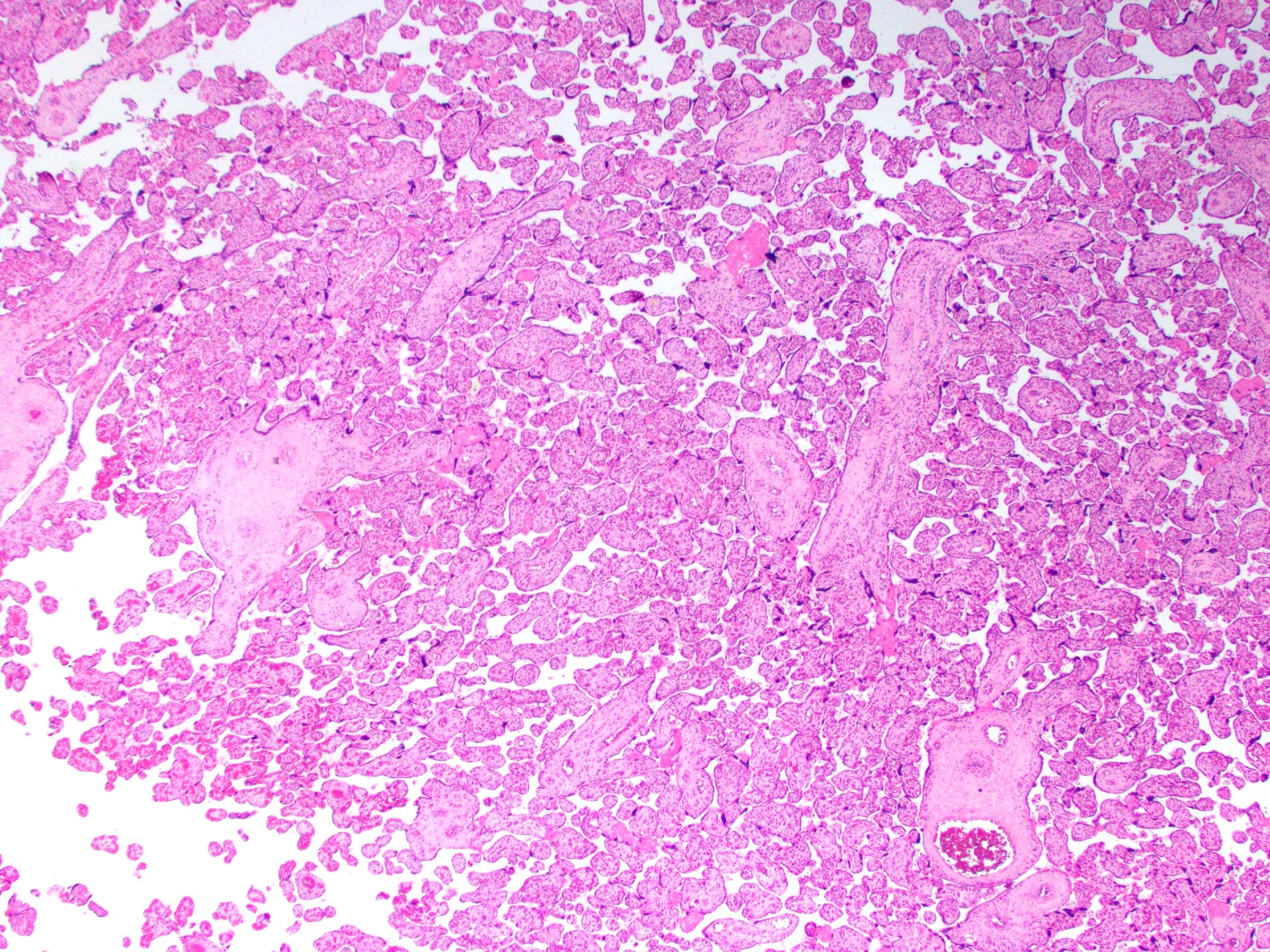 Pathology Outlines - Chorangiomatosis