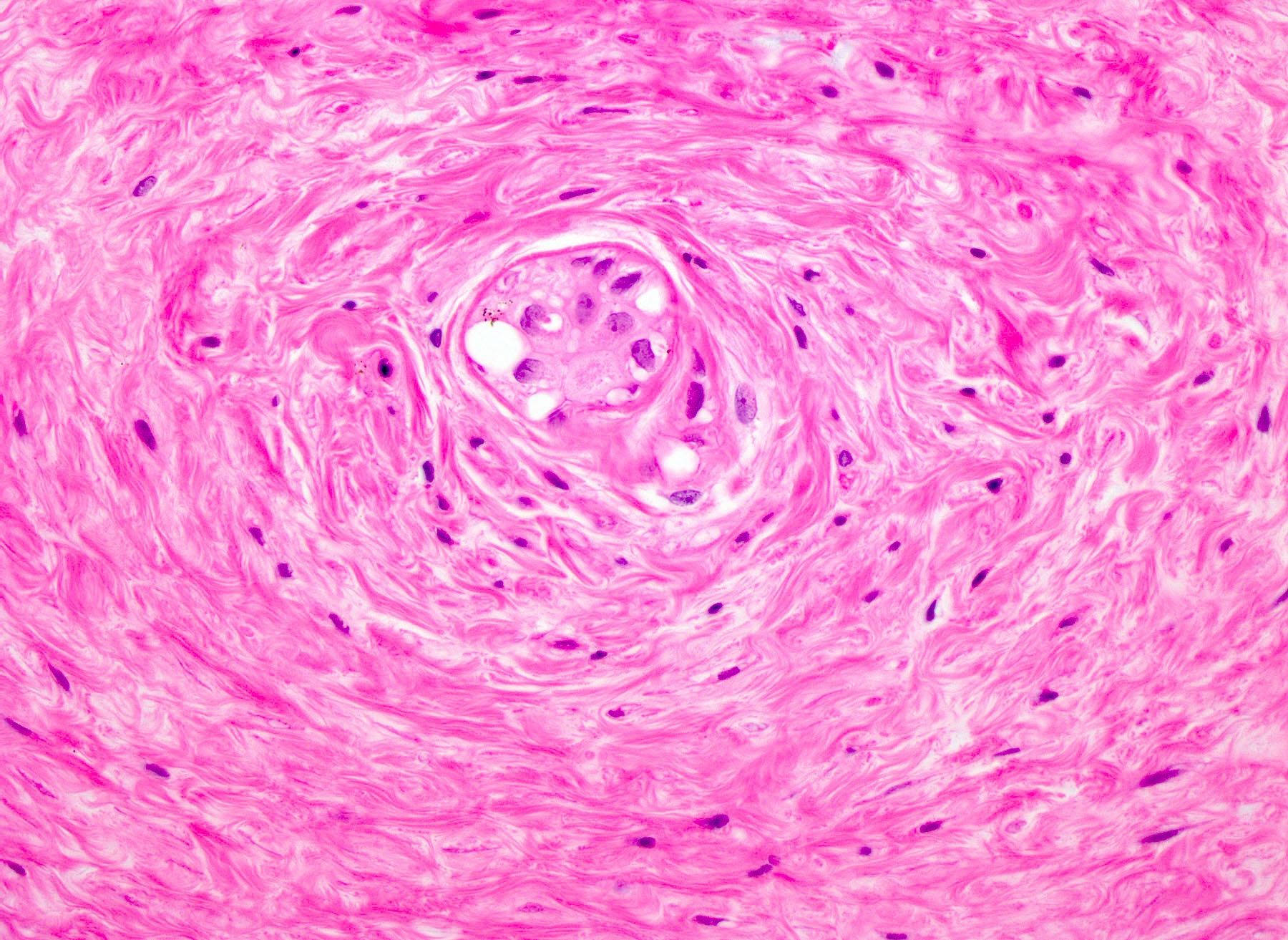 Pathology Outlines - Embryonic remnants