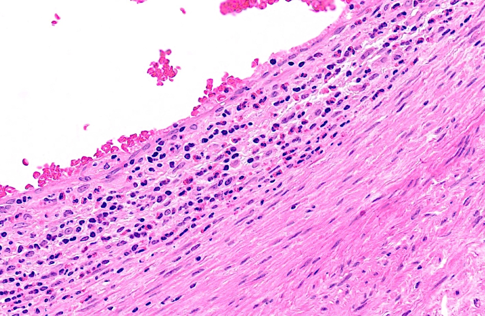 Pathology Outlines Eosinophils Pathology Outlines Eosinophils