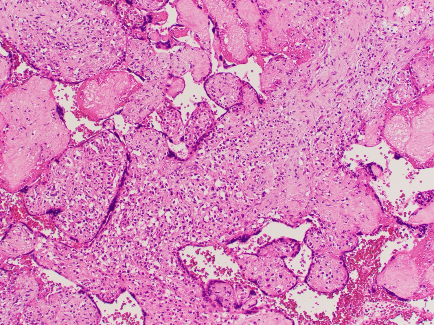 Pathology Outlines - Villitis of unknown etiology