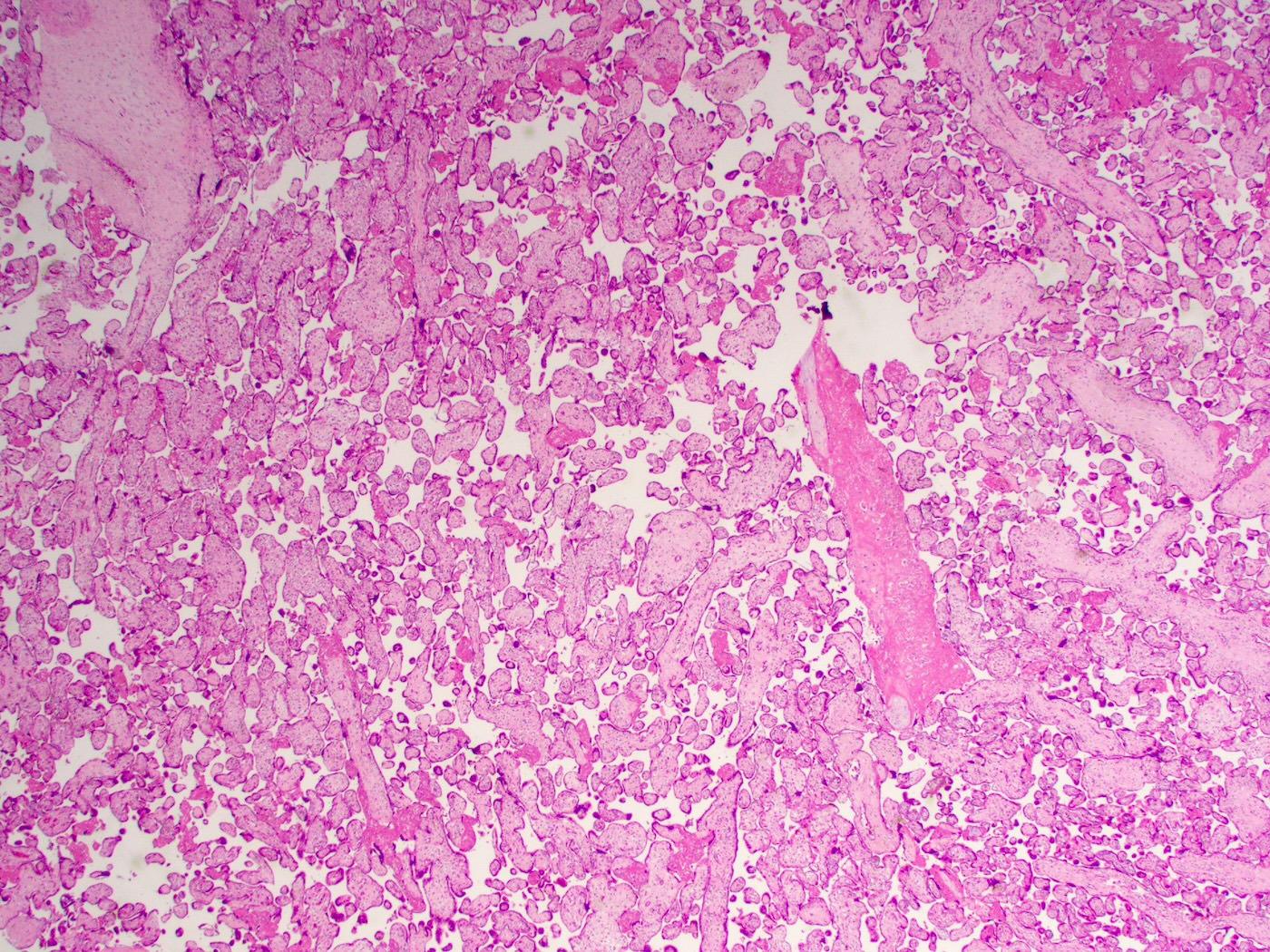Pathology Outlines - Villitis of unknown etiology