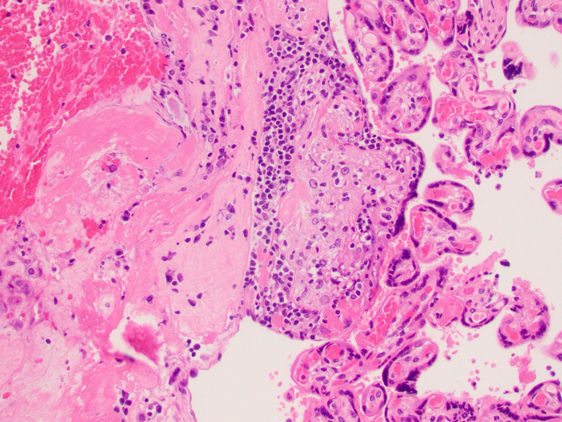 Pathology Outlines - Villitis of unknown etiology