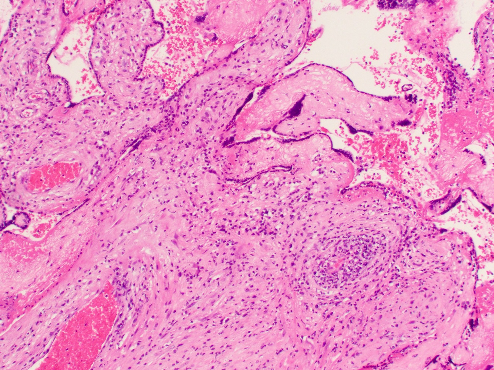 Pathology Outlines - Villitis of unknown etiology