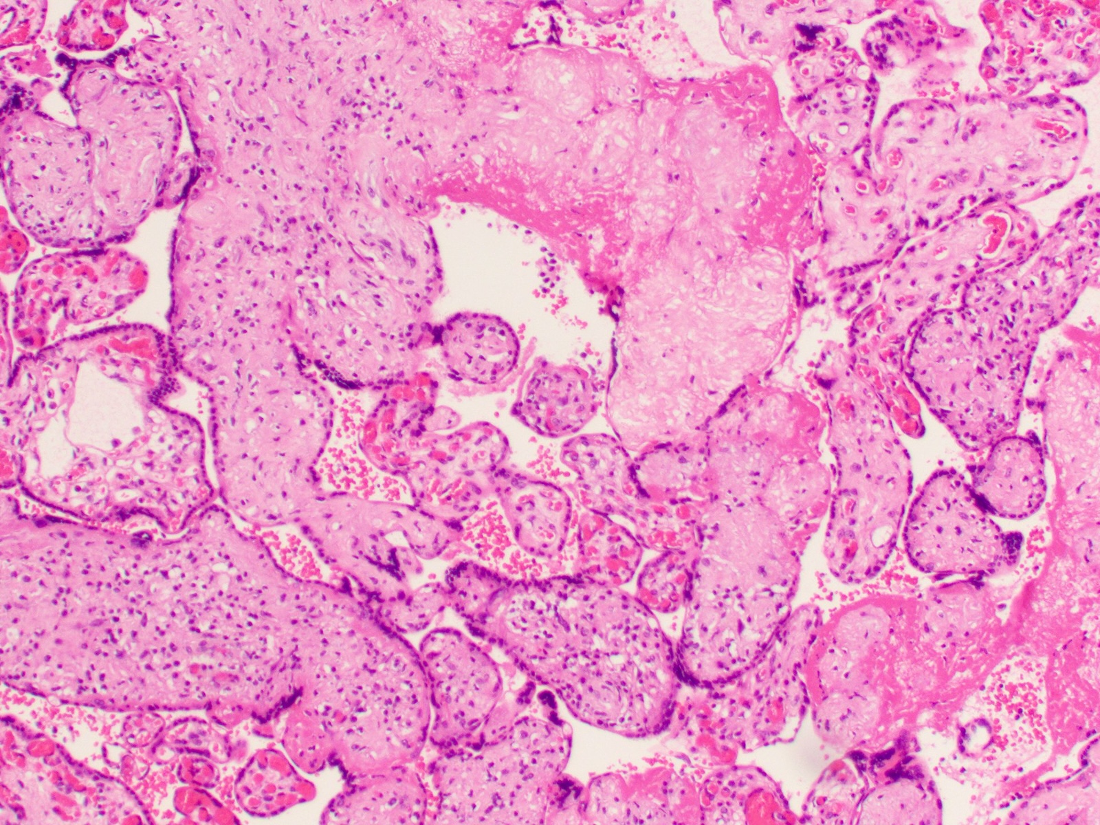 Pathology Outlines - Villitis of unknown etiology