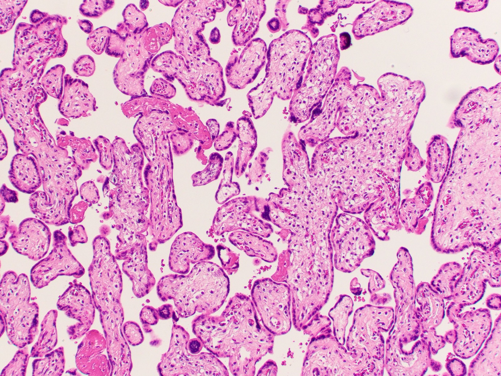 Pathology Outlines - Villitis of unknown etiology