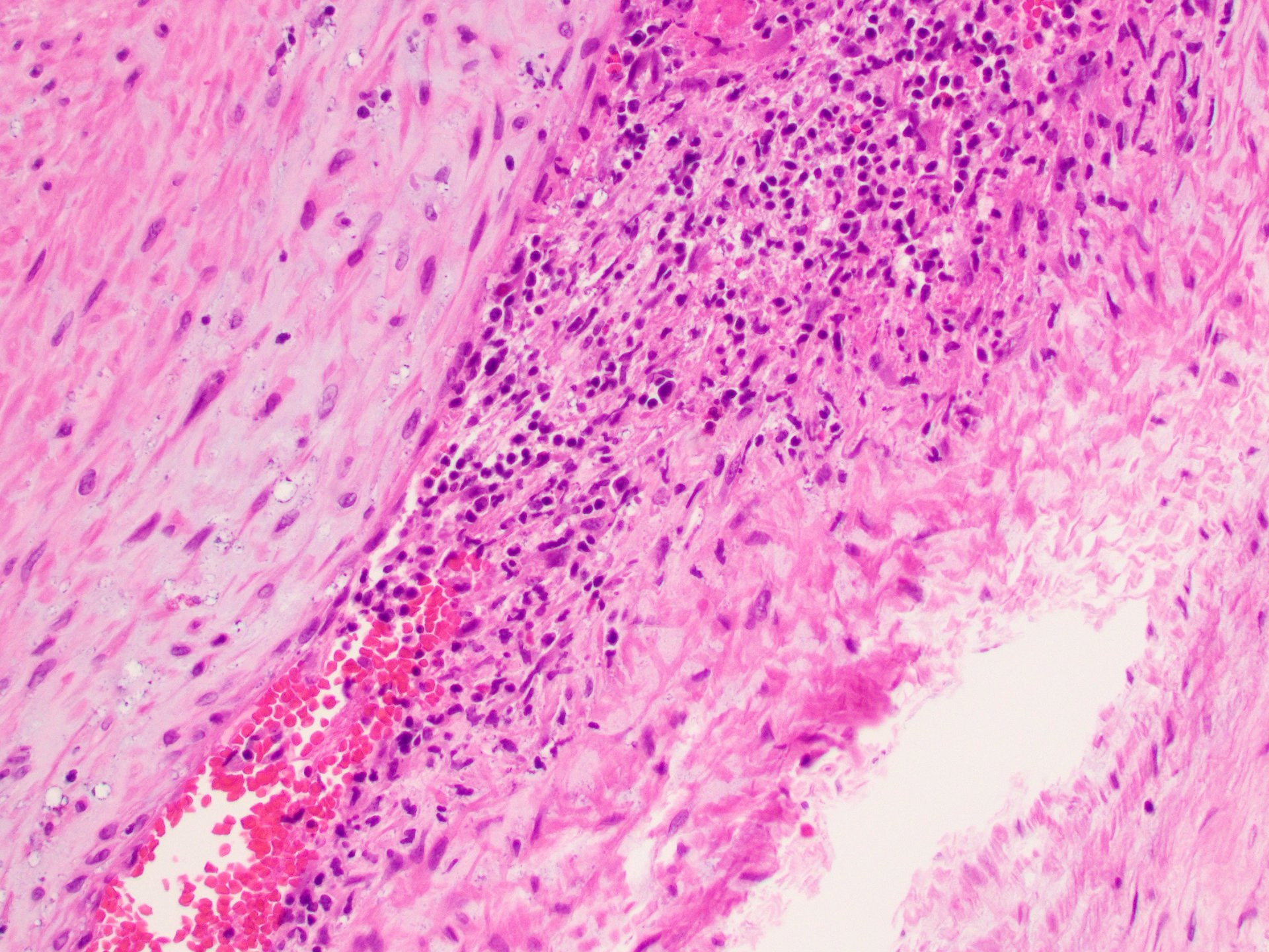 Pathology Outlines - Villitis of unknown etiology
