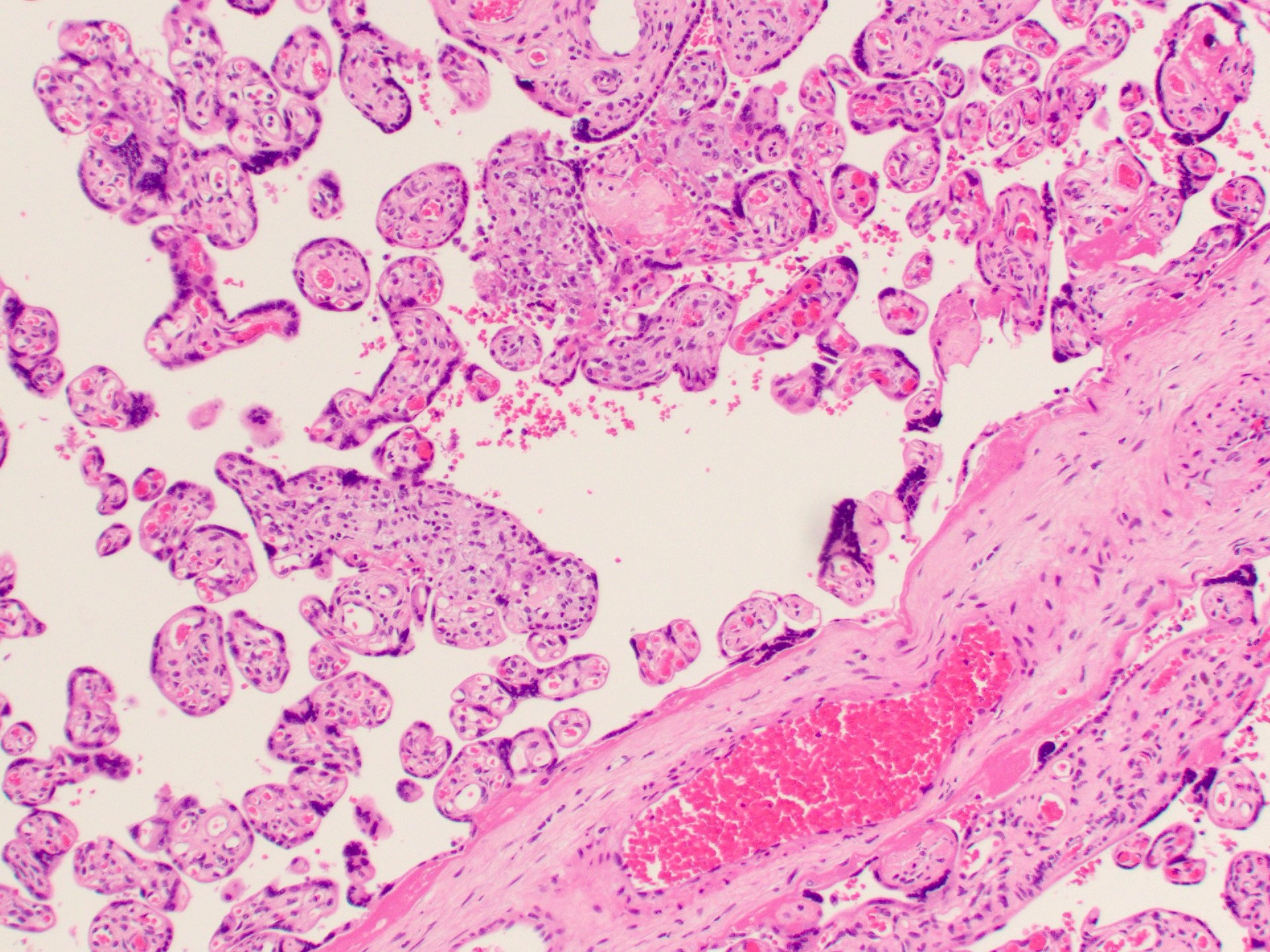 Pathology Outlines - Villitis of unknown etiology