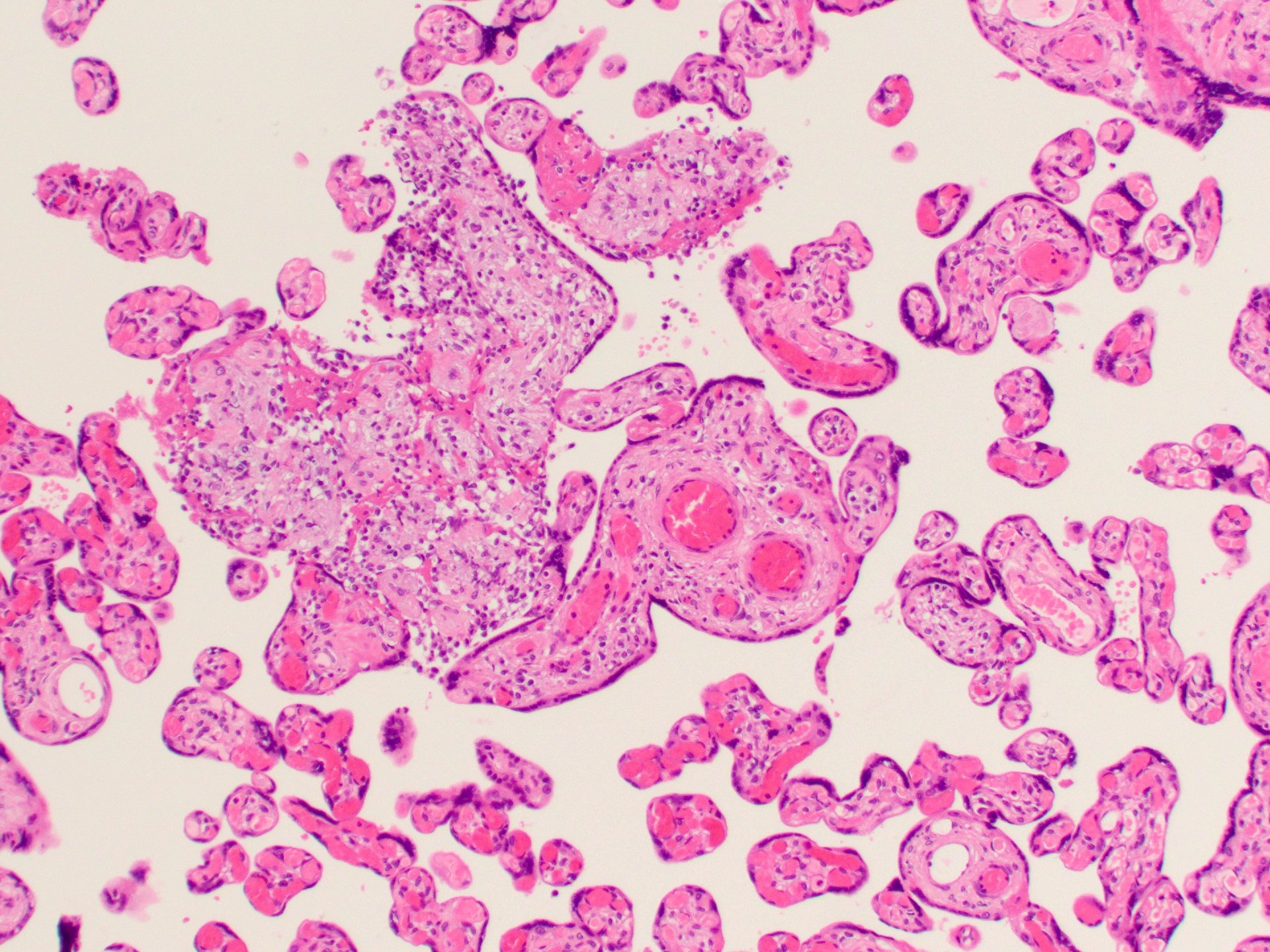 Pathology Outlines - Villitis of unknown etiology