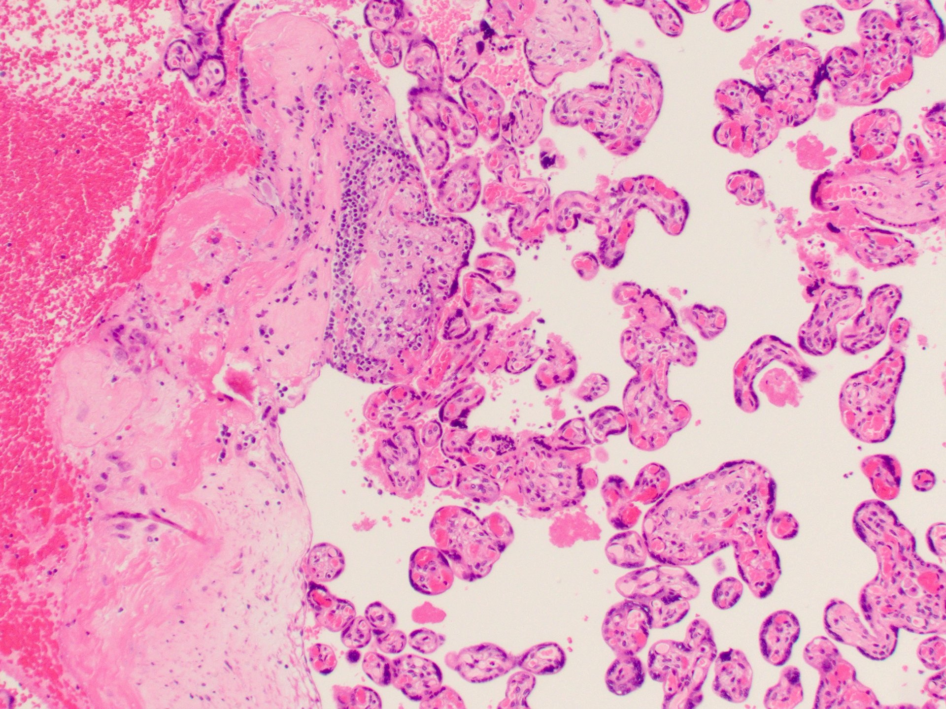 Pathology Outlines - Villitis of unknown etiology