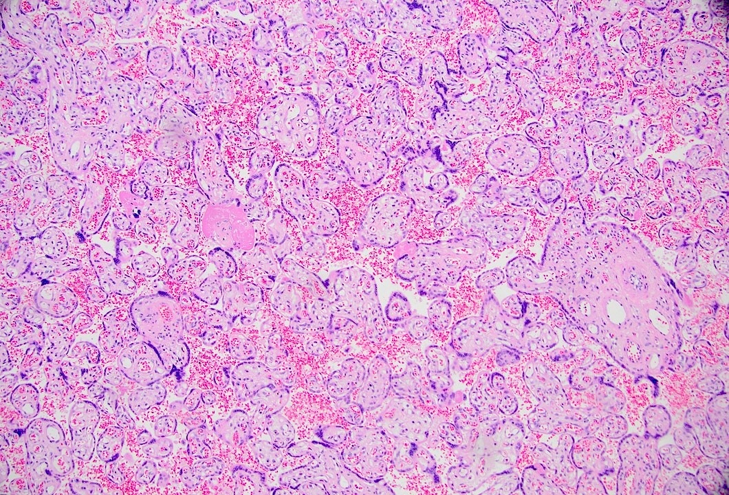 Pathology Outlines - Distal villous hyperplasia (villous dysmaturity ...