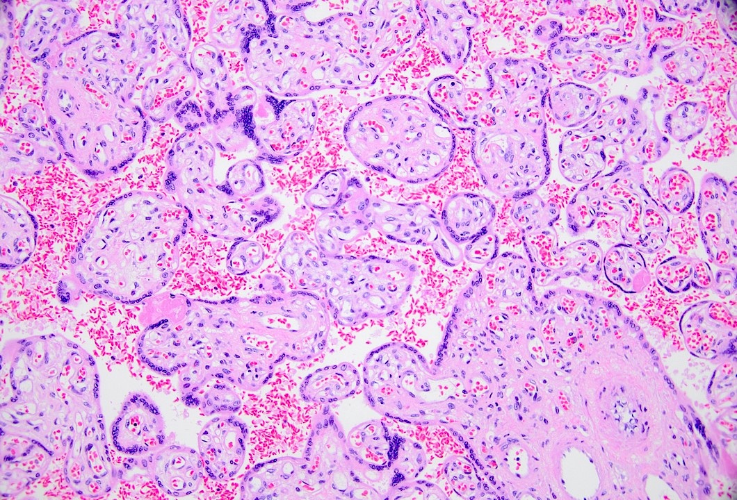 Pathology Outlines - Distal villous hyperplasia (villous dysmaturity ...