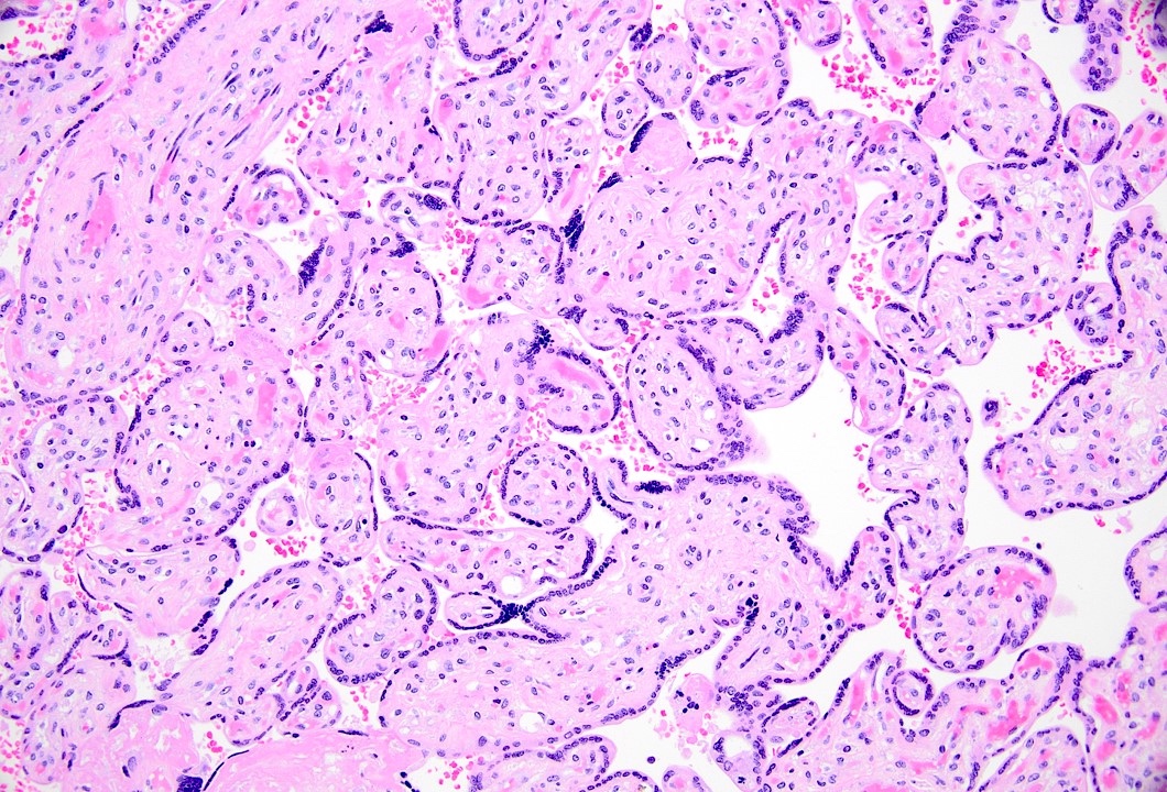 Pathology Outlines - Distal villous hyperplasia (villous dysmaturity ...