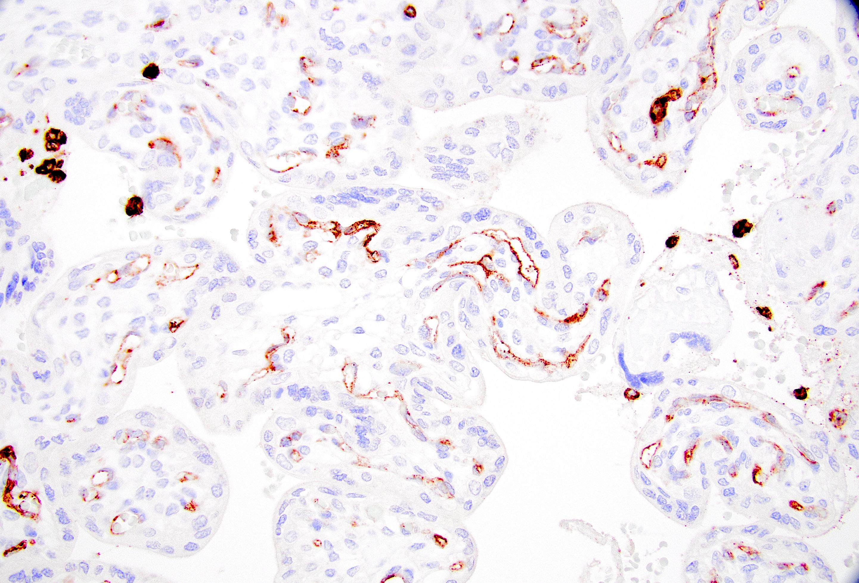 Pathology Outlines - Distal villous hyperplasia (villous dysmaturity ...