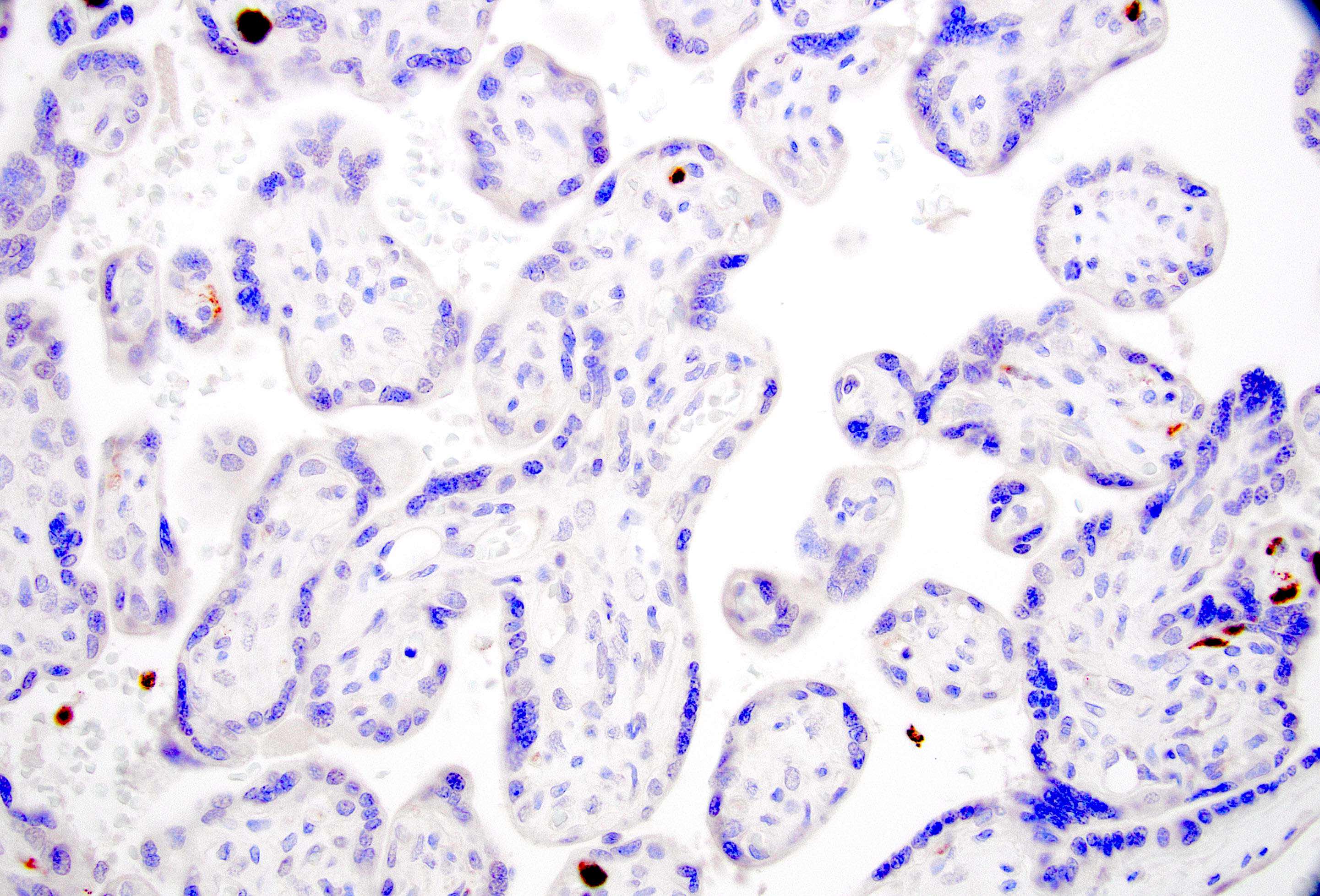 Pathology Outlines - Distal villous hyperplasia (villous dysmaturity ...