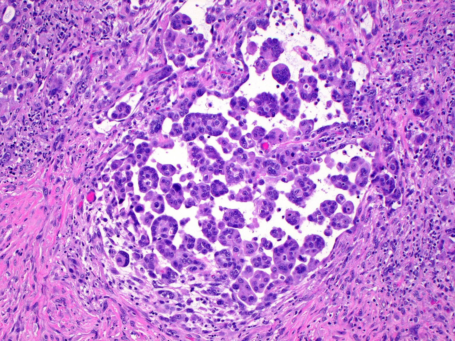 Pathology Outlines - Mesothelioma (pleura)-epithelioid