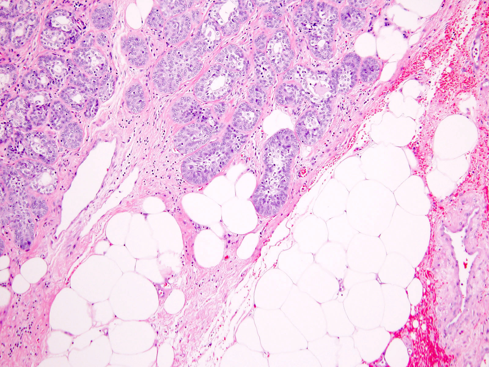Pathology Outlines - Adenoid cystic (basal cell) carcinoma