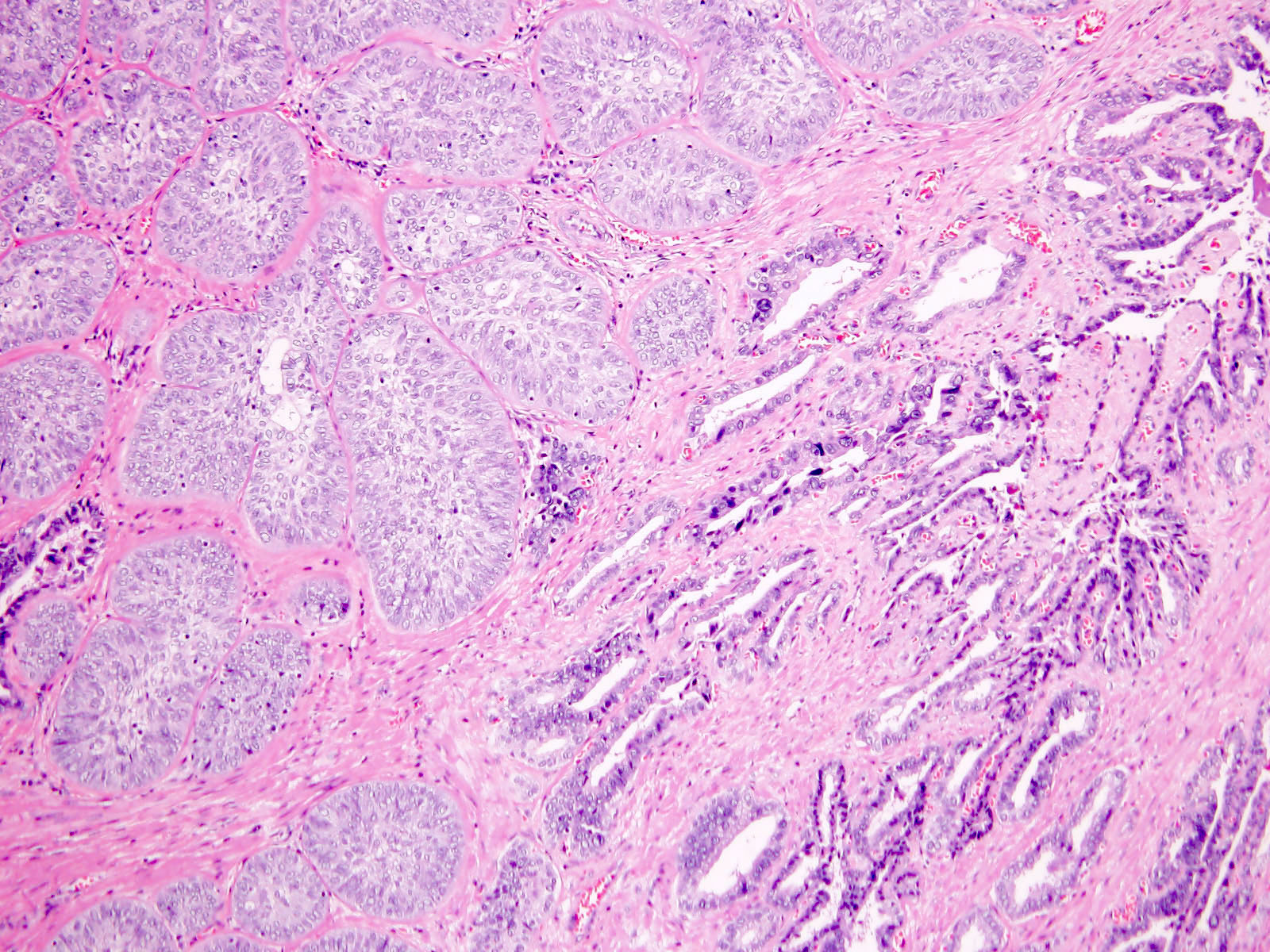 Pathology Outlines - Adenoid cystic (basal cell) carcinoma