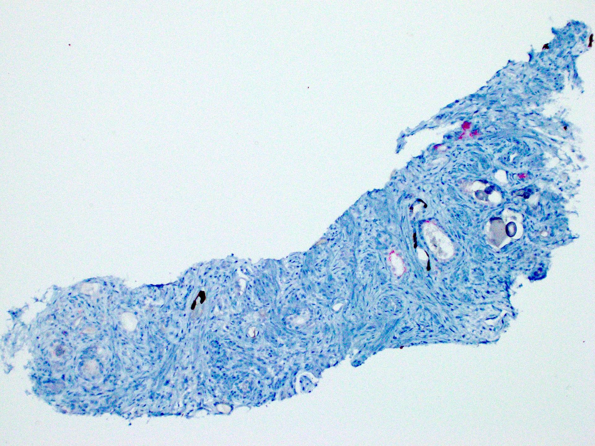 Pathology Outlines - Atrophic adenocarcinoma