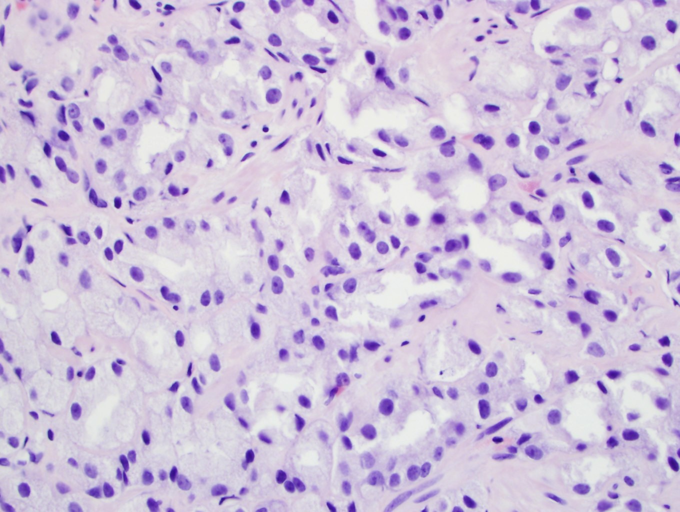 Pathology Outlines - Foamy gland adenocarcinoma