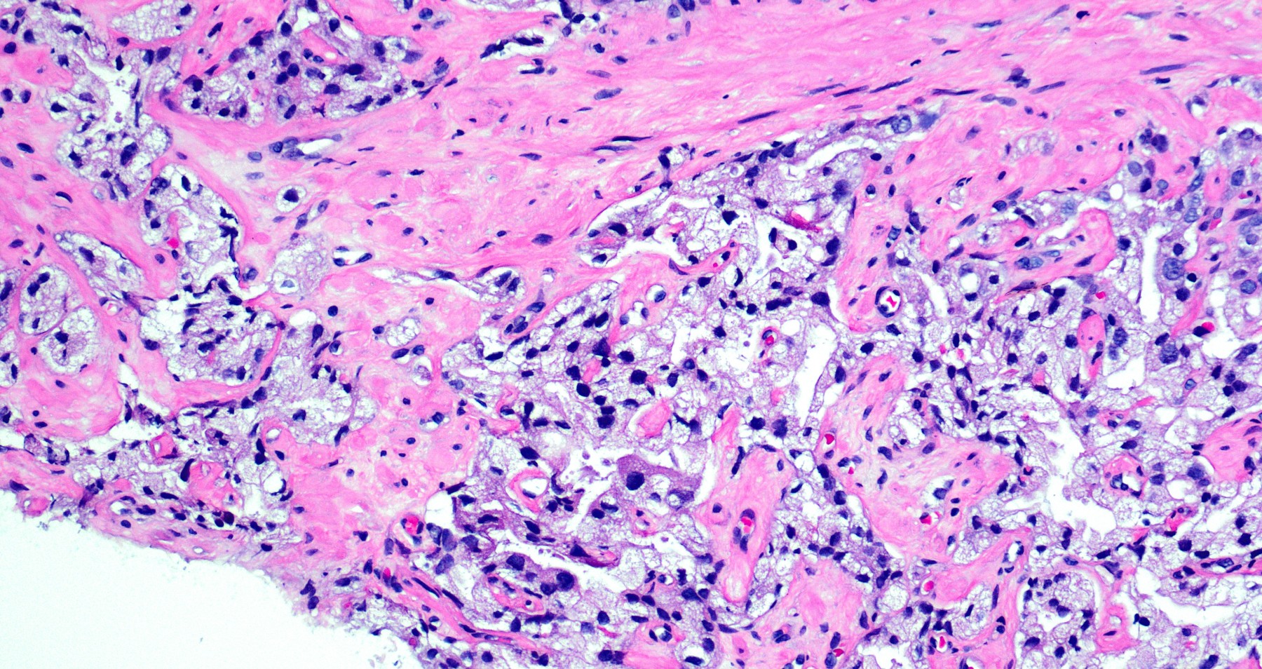 Pathology Outlines - Foamy gland adenocarcinoma