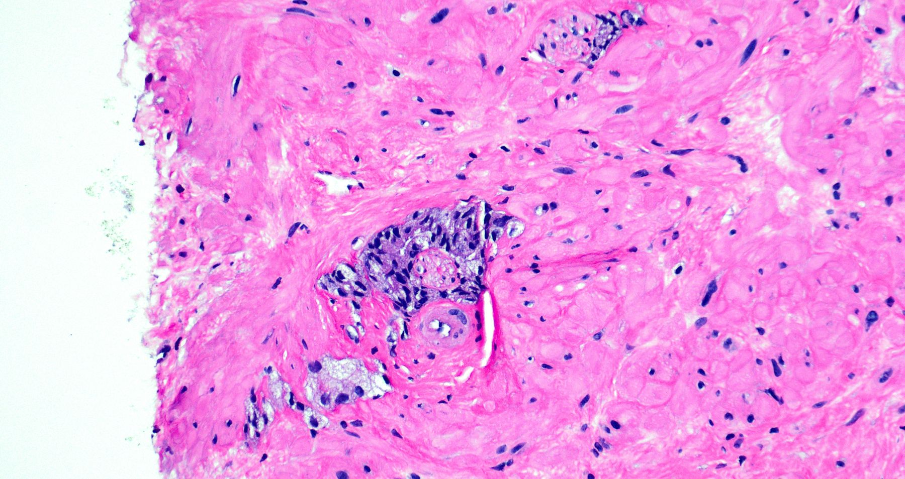 Pathology Outlines - Foamy gland adenocarcinoma