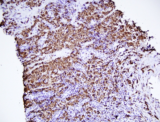 Pathology Outlines - Foamy gland adenocarcinoma