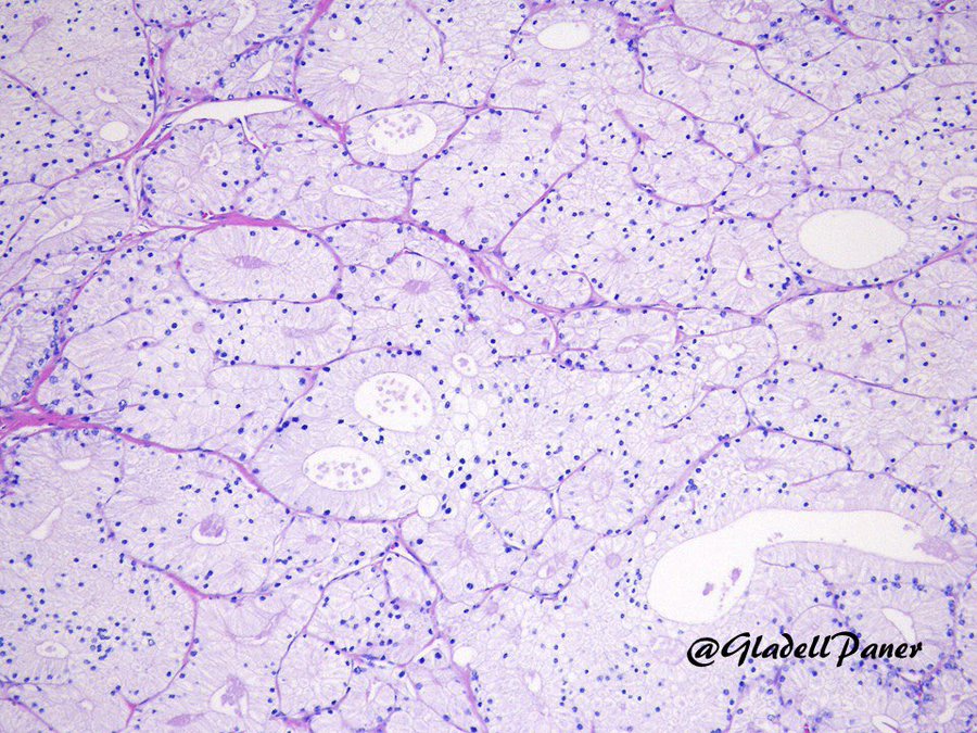 Pathology Outlines - Foamy gland adenocarcinoma