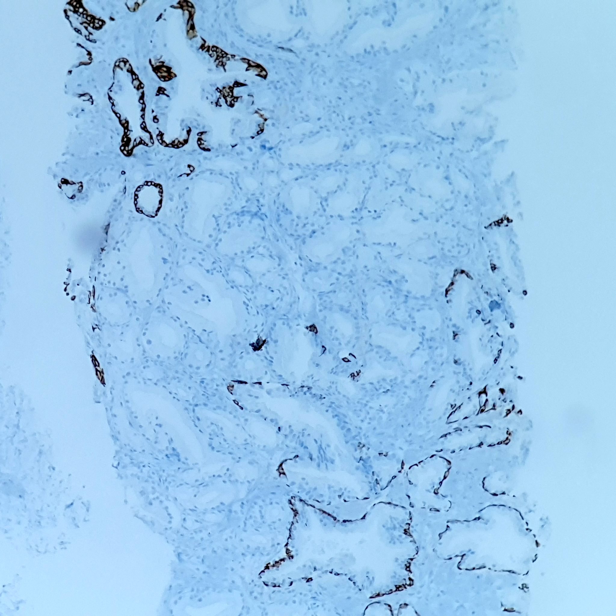 Pathology Outlines - Foamy gland adenocarcinoma