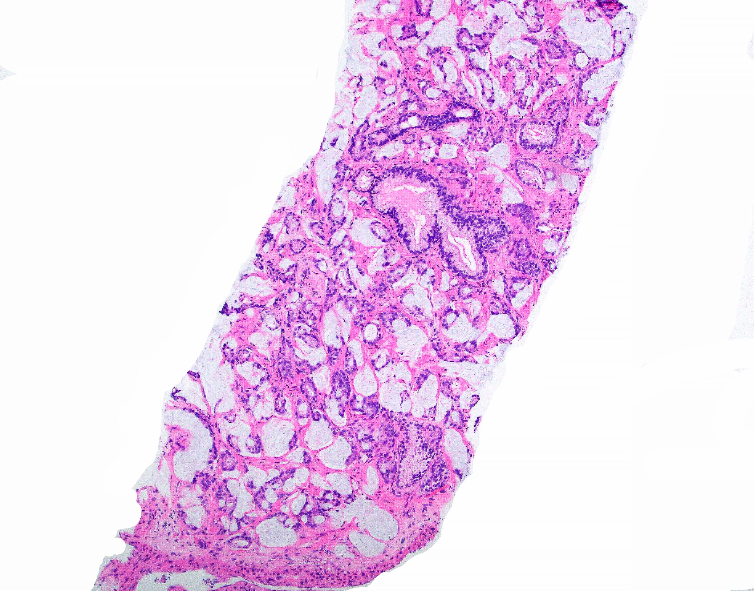 Pathology Outlines - Mucinous (colloid) adenocarcinoma