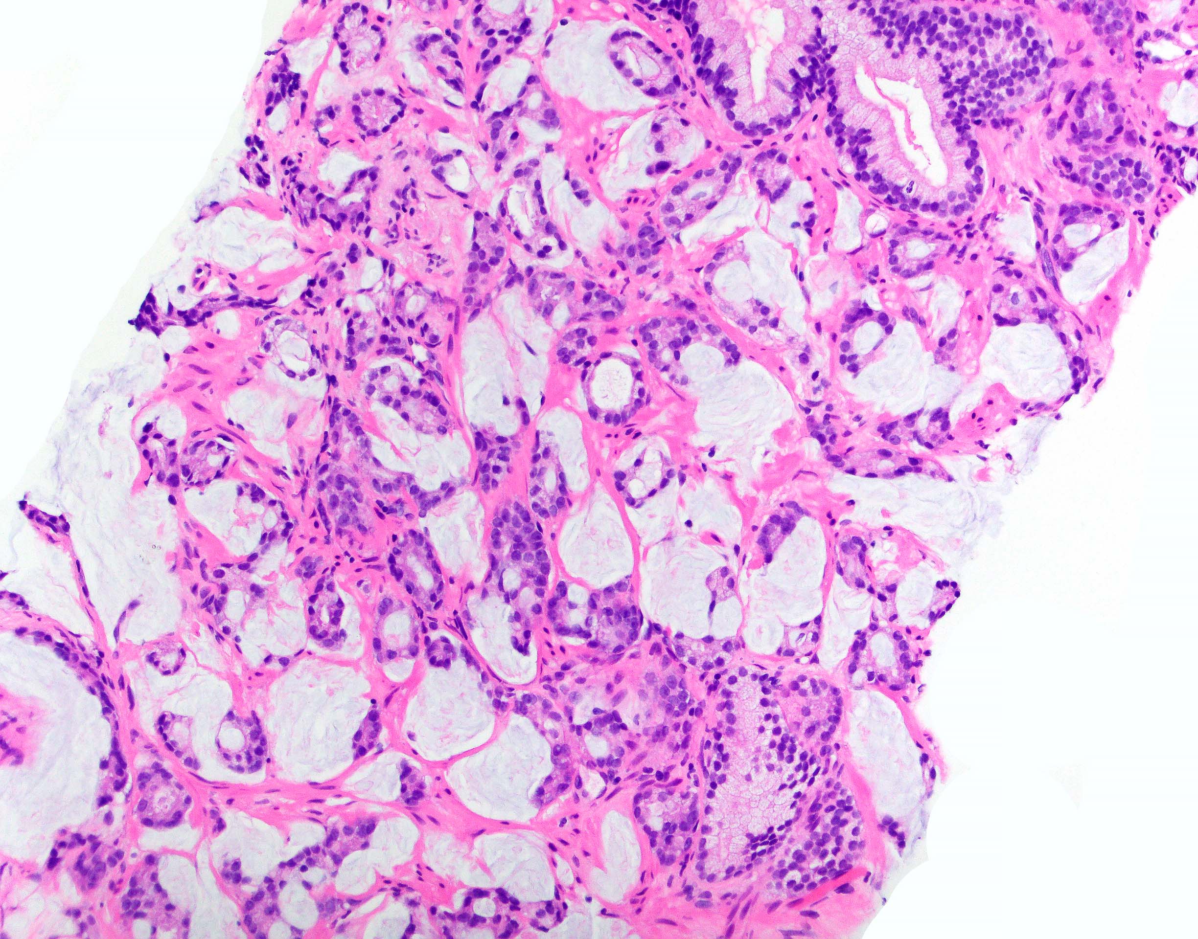 Pathology Outlines - Mucinous (colloid) adenocarcinoma