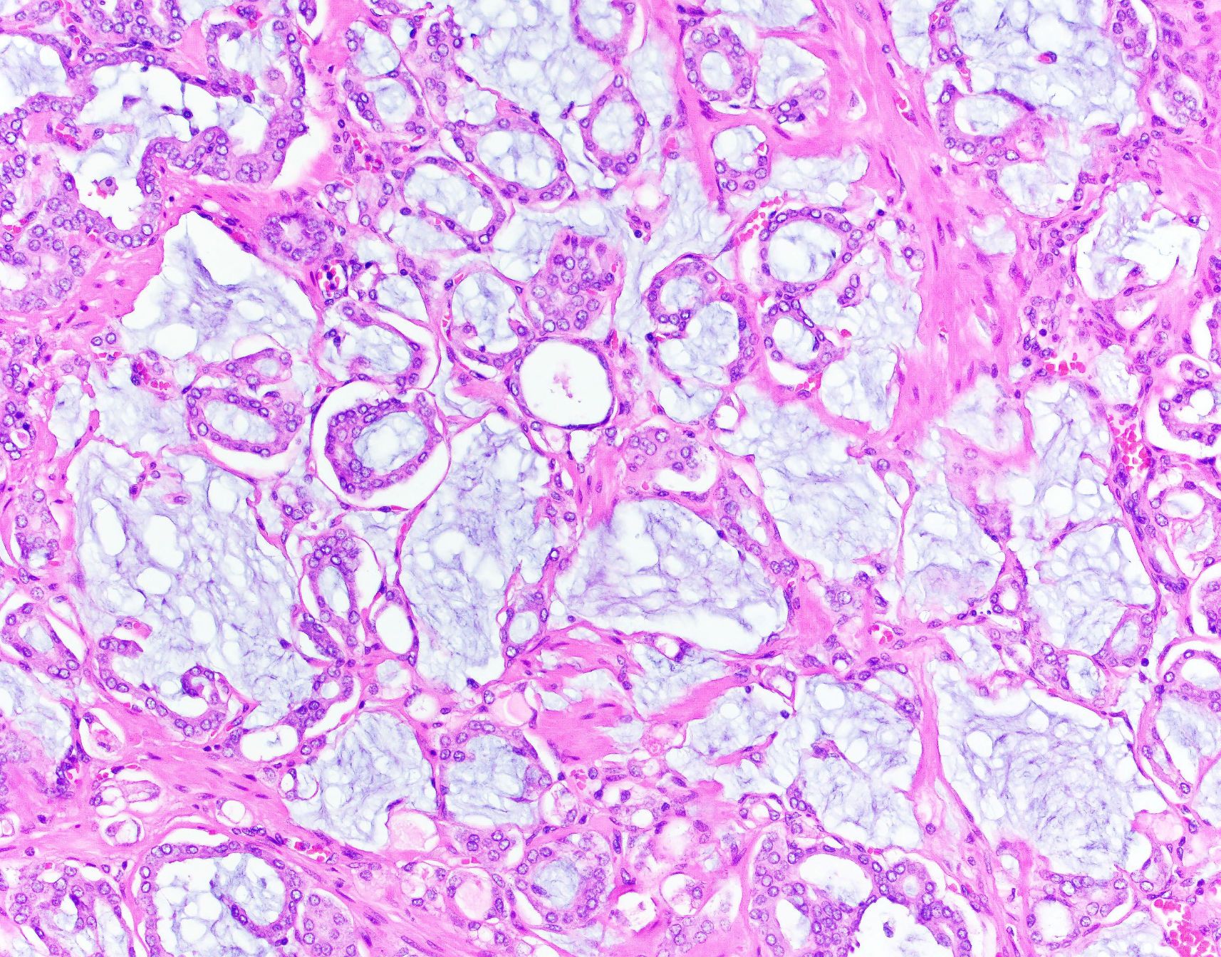 Pathology Outlines - Mucinous (colloid) adenocarcinoma