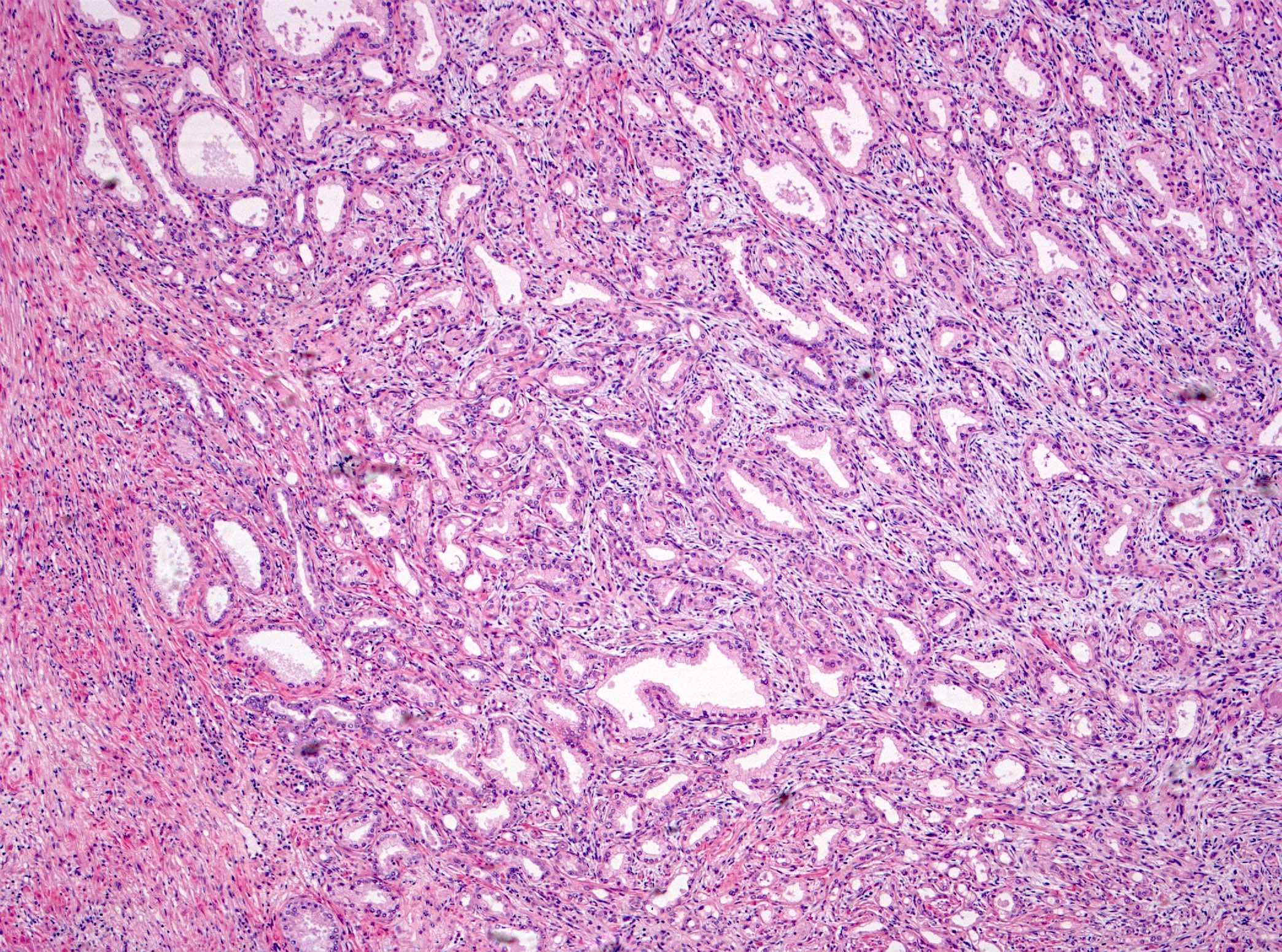 Pathology Outlines - Sclerosing adenosis