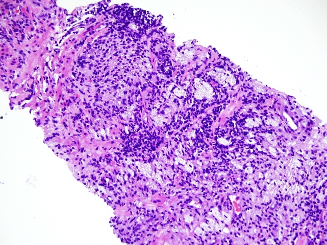 Pathology Outlines - Prostatitis