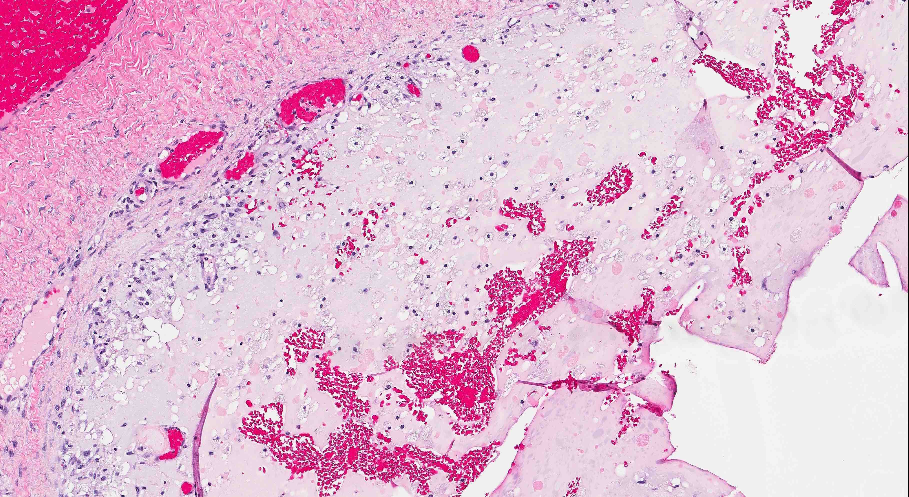 Pathology Outlines - Ranula